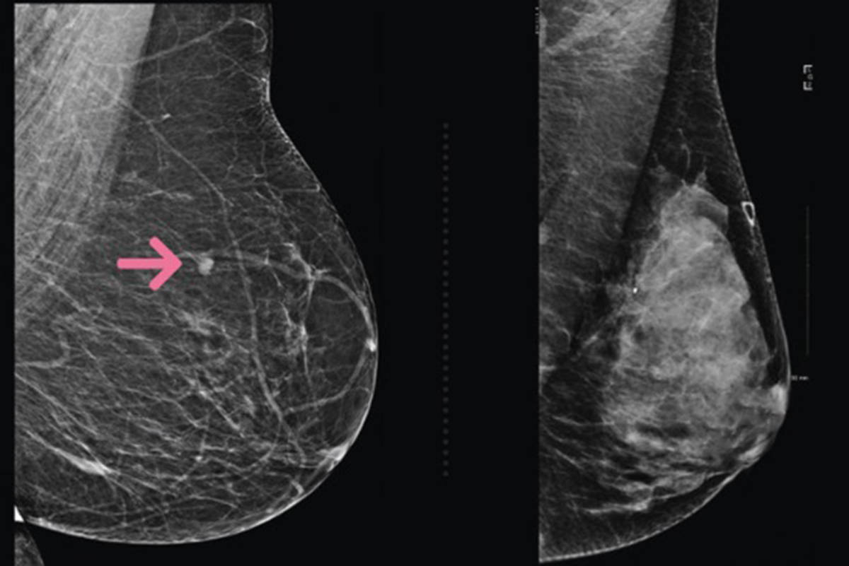 Mammogram Shows Abnormality